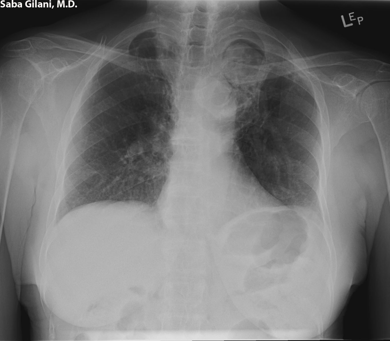 Roentgen Ray Reader: The Air Crescent Sign