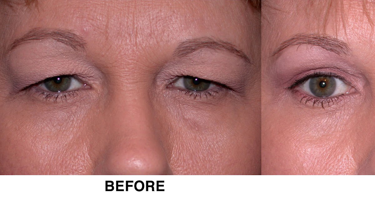 What Is Blepharoplasty ~ Get Updated With Medical News Yourmedcoach