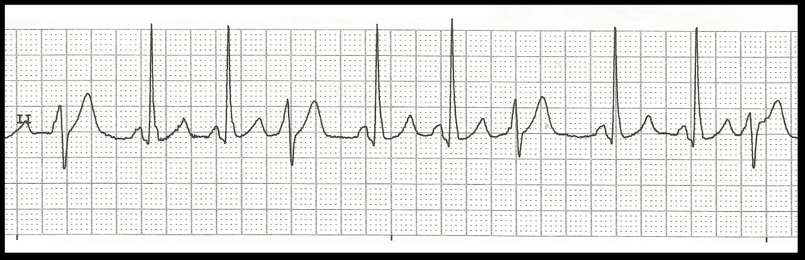 EKG Rhythm Strip Quiz 128