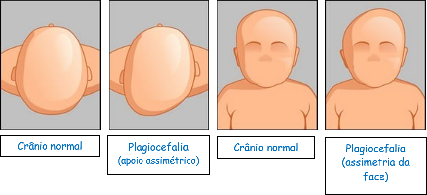 O Blog da Tia Paula (pediatra): Plagiocefalia Posicional/ Assimetria ...