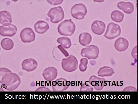Lab Atlas: Hemoglobin C Crystals