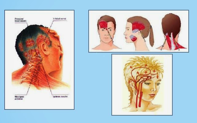 Develando la Salud: La cefalea tensional