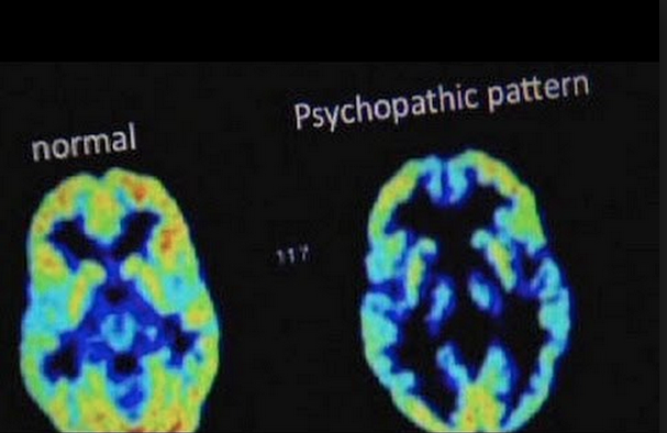 More Brain Points: The Brain of a Psychopath
