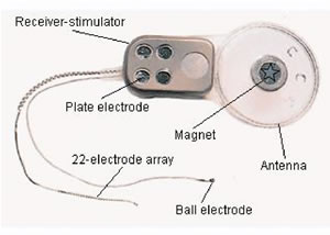 The Site for Healthcare Professionals: Cochlear Implant.