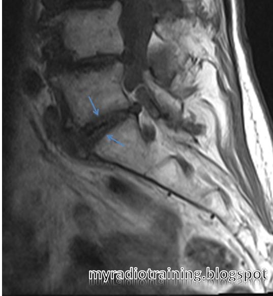 Radiology info hub: Modic changes in MRI