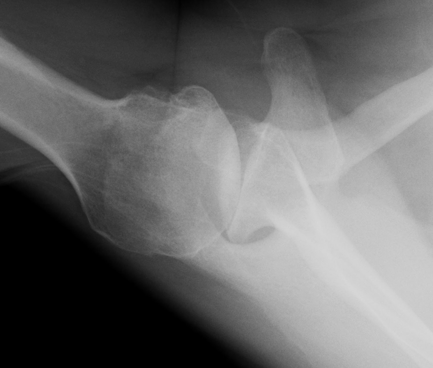 UW Shoulder and Elbow Academy: How bad is the shoulder arthritis on x-ray?