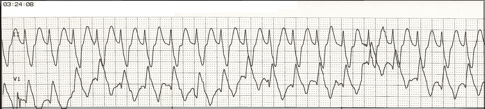 EKG Rhythm Strip Quiz 55: Ventricular Rhythms