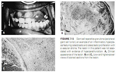Burket’s Oral Medicine: Giant Cell Granuloma (Peripheral and Central)