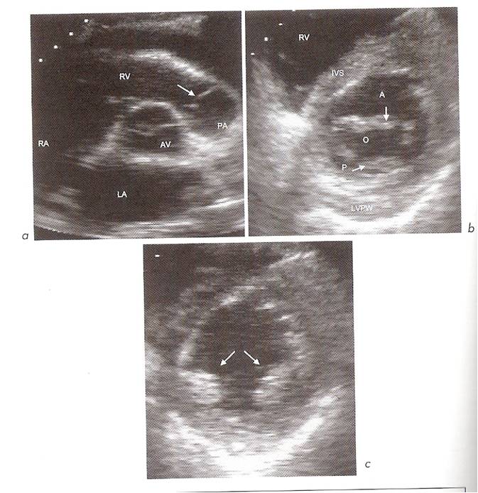 CVT Mohd Farid: Basic Echo Window :Parasternal Short Axis View