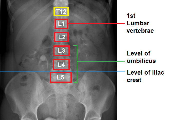 HS2135 Statistics Project - Can the umbilicus be a good indicator of ...