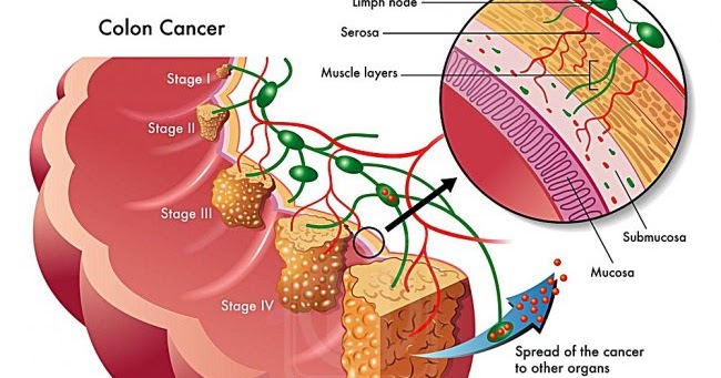 5 Jenis Kanser Utama Yang Biasa Menyerang Kaum Adam