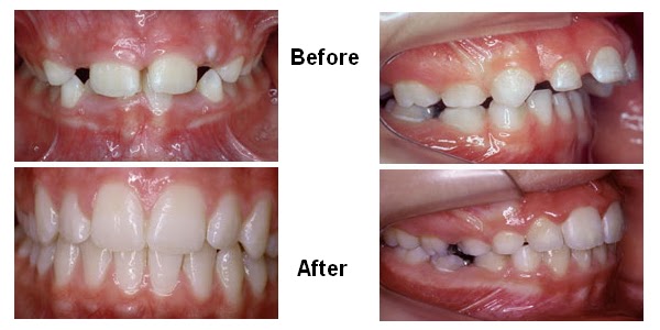 Crystal Lake Dental's Hot topics: New Orthopedic and Orthodontic ...