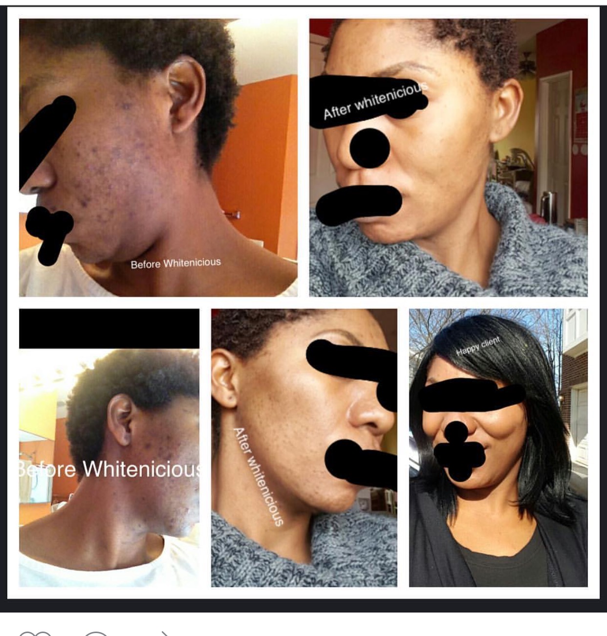 Dencia Before And After