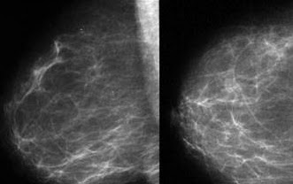 What is Mastitis | Nice Breastfeeding Blog