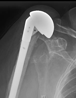 UW Shoulder and Elbow Academy: Reverse total shoulder - dislocations ...