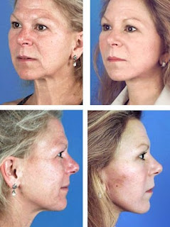 Flexing Your Face With Facial Gymnastics To Gain A Non-Surgical ...