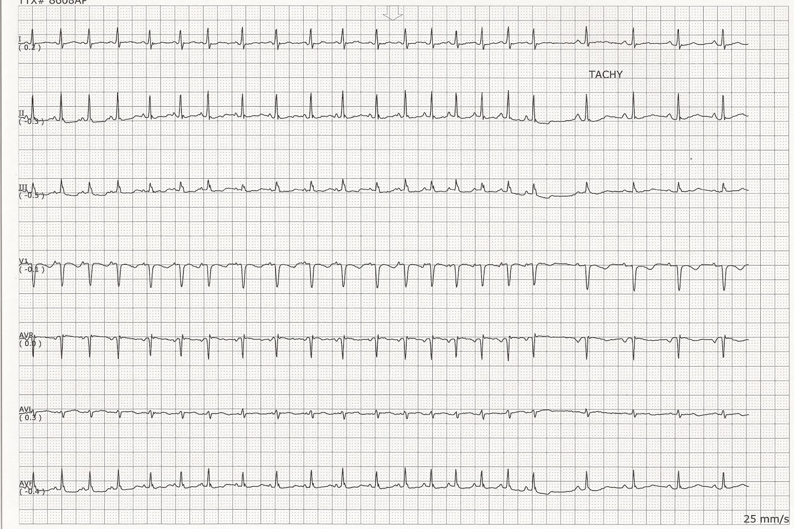 Paroxysmal Atrial Tachycardia