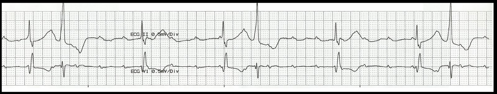 Practice EKG Rhythm Strips 156