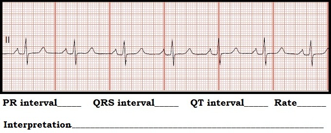 ECG Rhythm Strip Quiz 81: Interval measurements