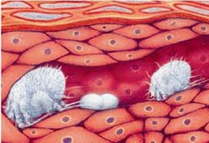 A LUZ DA ENFERMAGEM : Escabiose (ou Sarna)