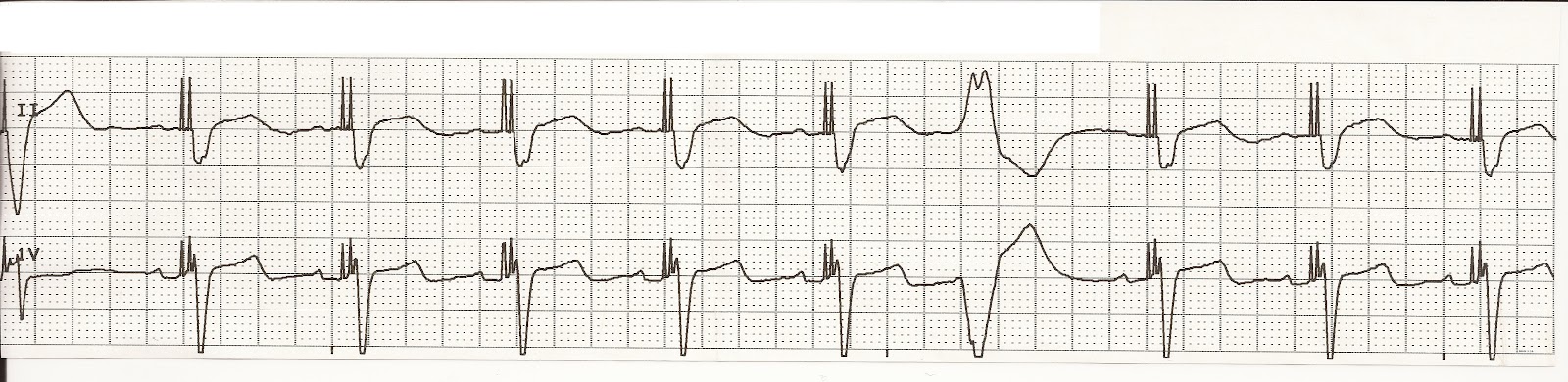 Biventricular Pacemaker