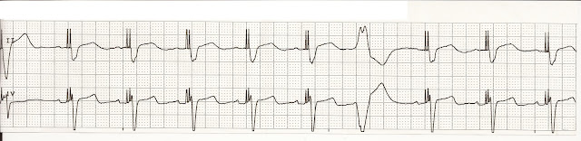 EKG Rhythm Strip Quiz 56: Paced Rhythms