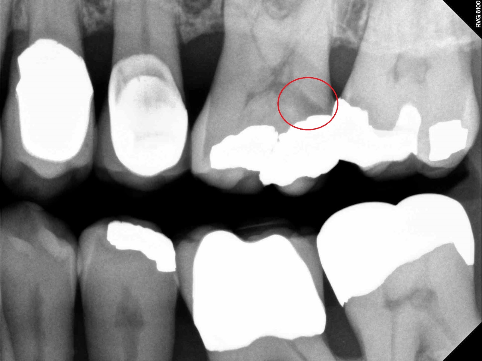 Molar root canal with resorption - Bauer Smiles
