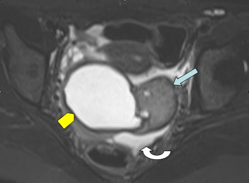 mricases: Ovarian Torsion