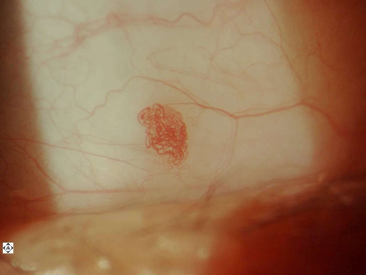 Sonoran Desert Eye Center: CONJUNCTIVAL VASCULAR ANOMALY