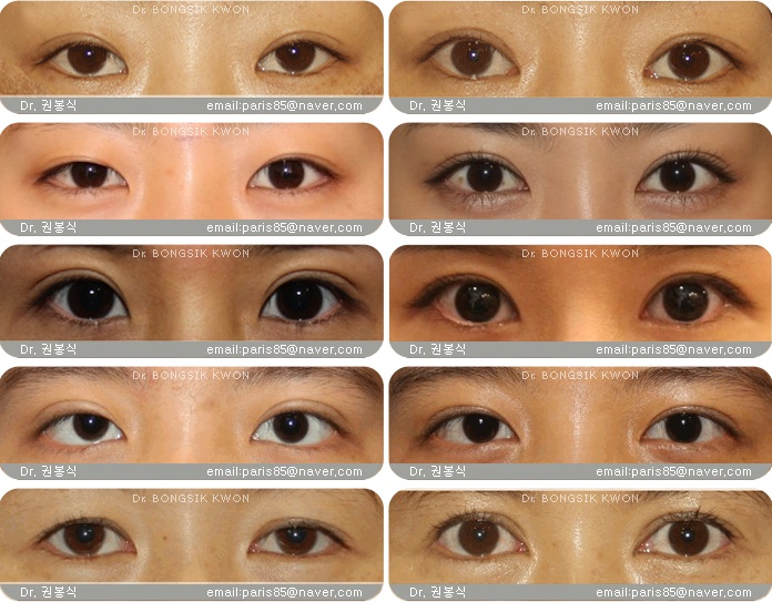 Teuim Aesthetic Plastic Surgical Clinic Dr.Kwon: 11월 2015