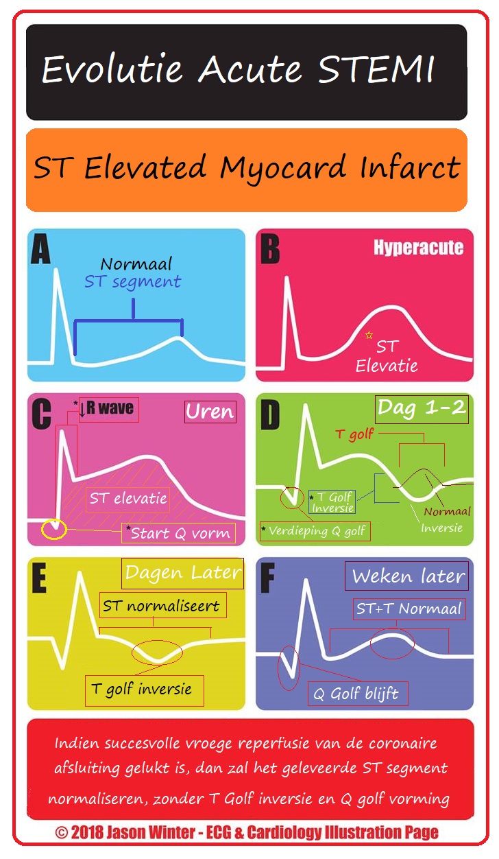 Fases Myocard Infarct - Acute Zorg Blog