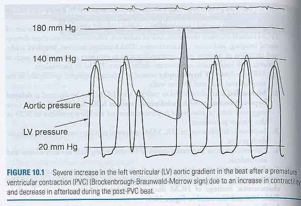 Pedi cardiology: HCM - Post-extrasystolic potentiation