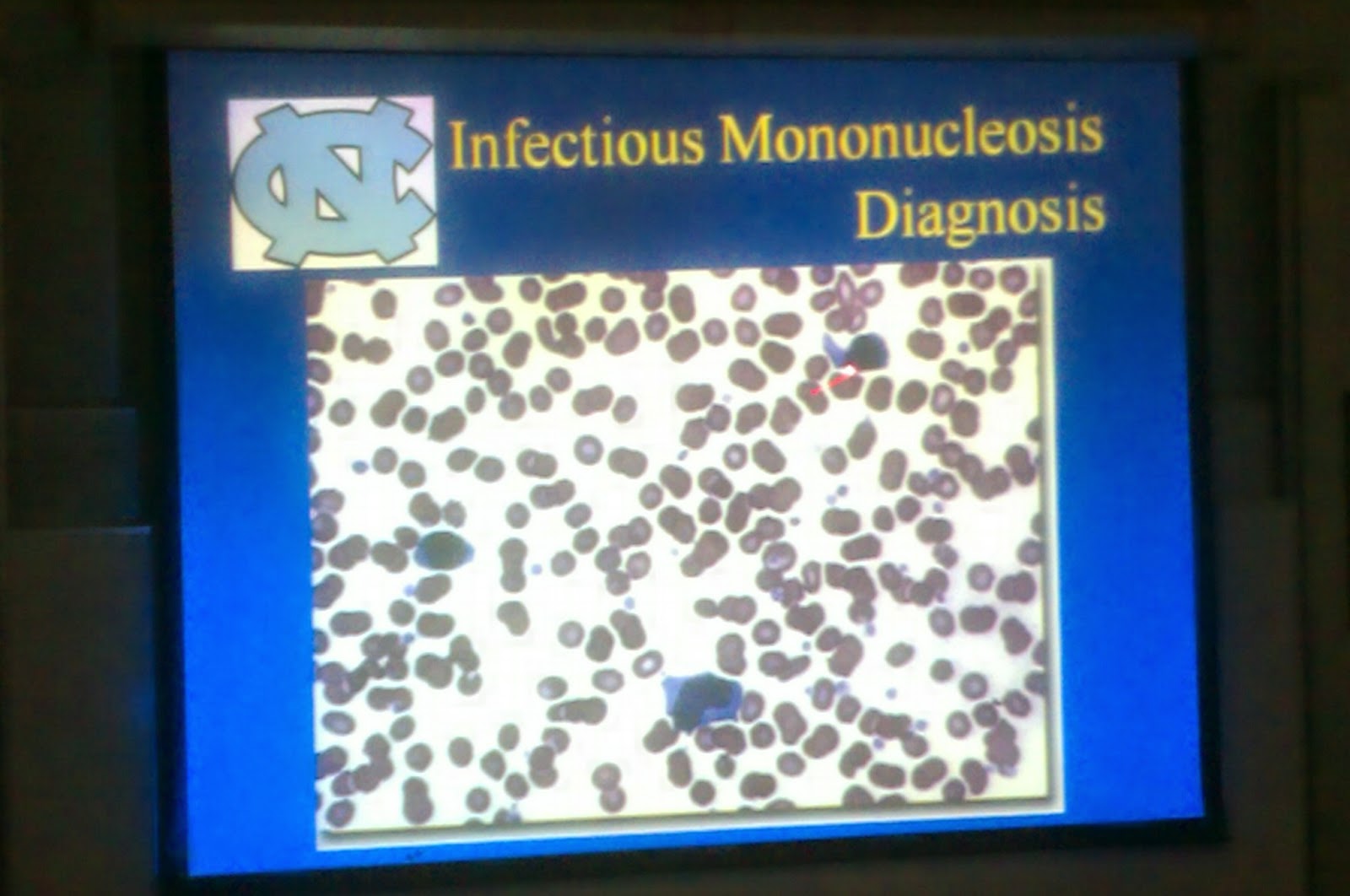Lecture slides: Medicine; INFECTIOUS MONONUCLEOSIS