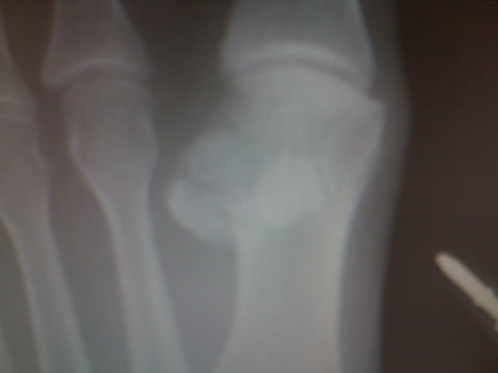 Foot and Ankle Problems By Dr. Richard Blake: Fractured Sesamoid: Email ...