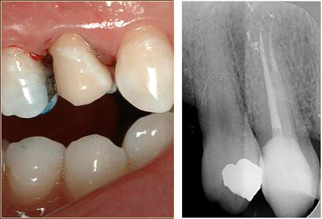 Clinica Omega: Reconstrucción con perno