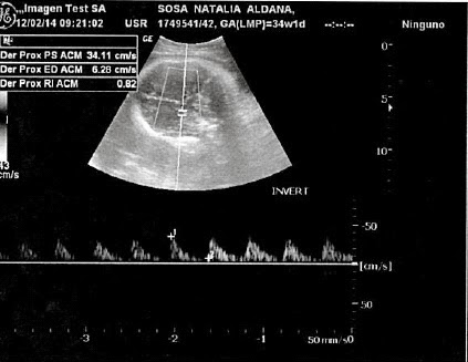 El blog de Rocío: Ecografía Obstétrica con Doppler (Semana 34)