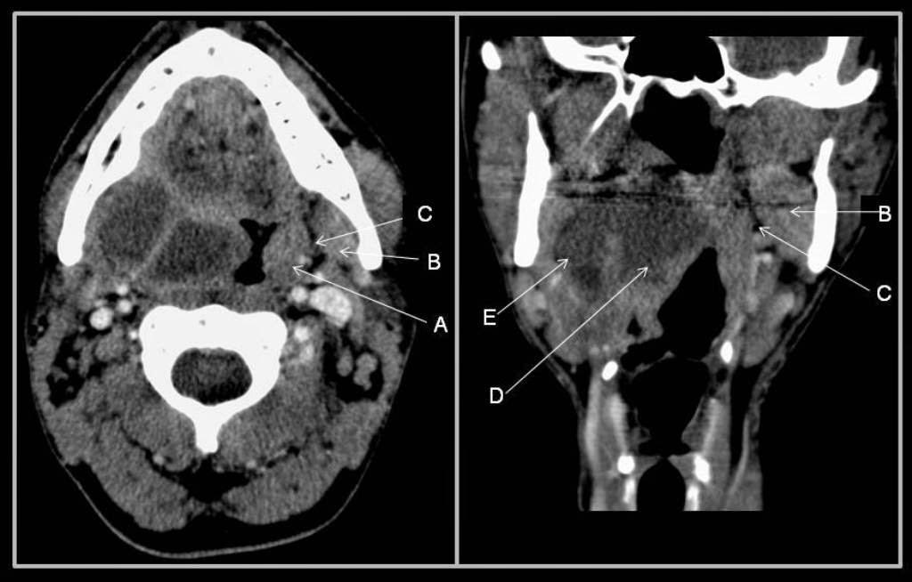 SALUDando a Los Cabos: Absceso periamigdalino