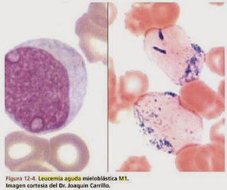 HEMATOLOGIA: LEUCEMIA MIELOIDE AGUDA M1 (CLASIFICACIÓN FAB)