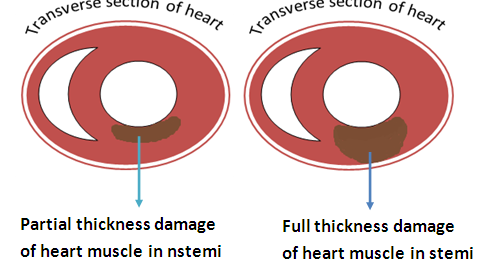 Online Medical Help: NSTEMI vs STEMI