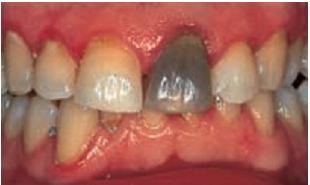 Necrosis de la Pulpa Dental; Gangrena de la Pulpa Dental; Autólisis de ...