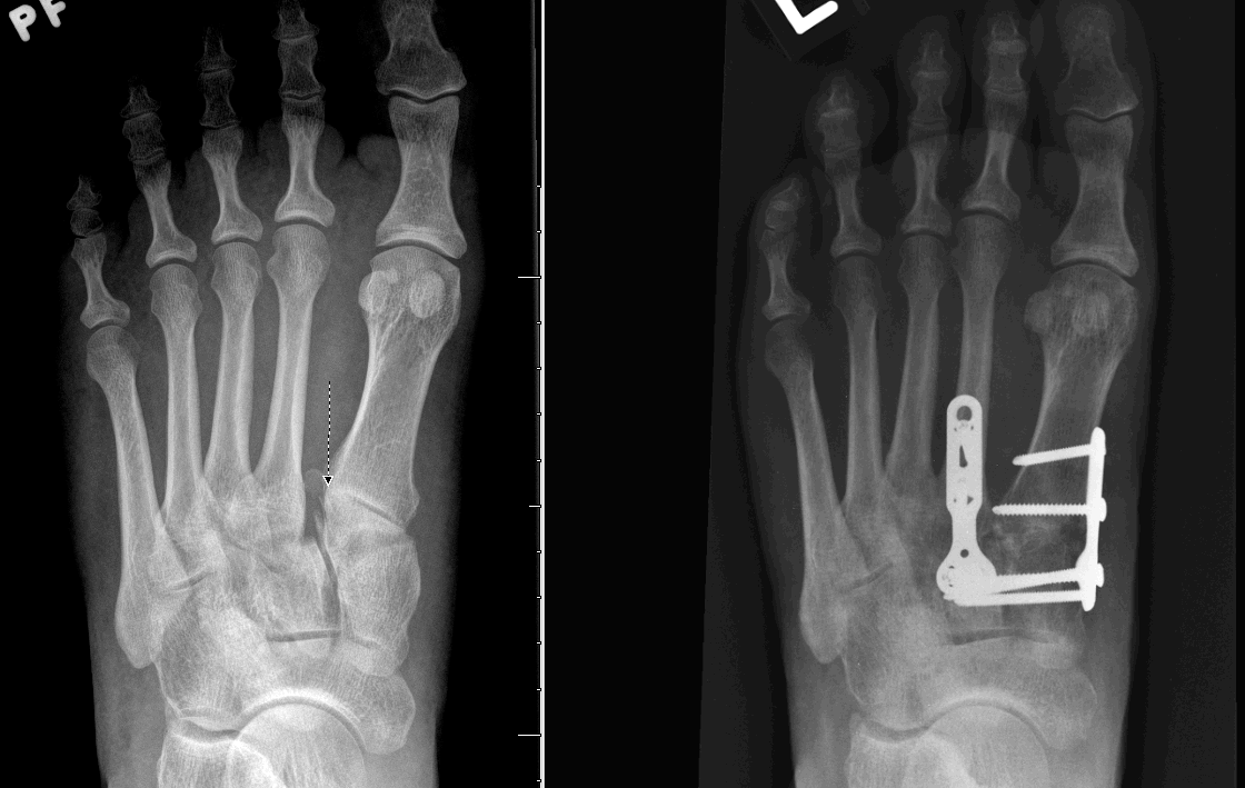 www.lisfranc.ca - Lisfranc Fracture / Injury Blog: Lisfranc / Midfoot ...