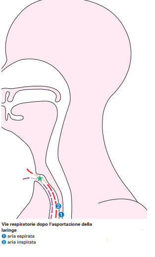 Laringe artificiale - Искусственная гортань - Artificial larynx ...