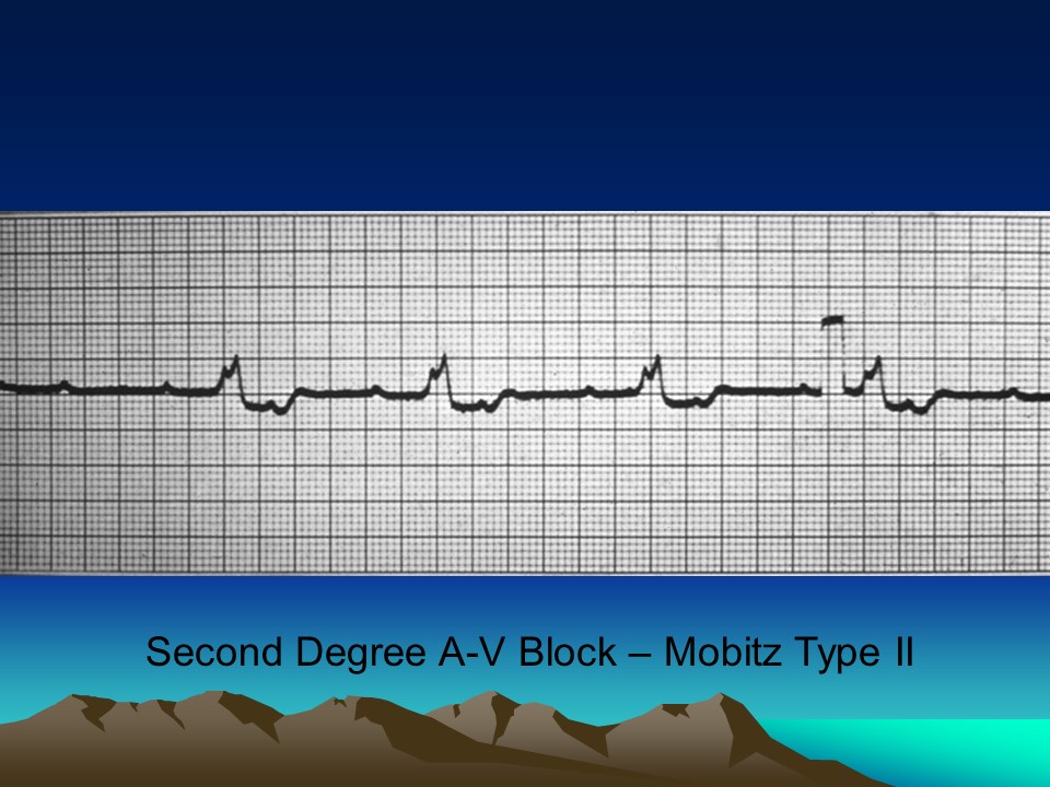 CVT Mohd Farid: Electrocardiogram ECG Part III Basic ECG Rhythm Pattern ...