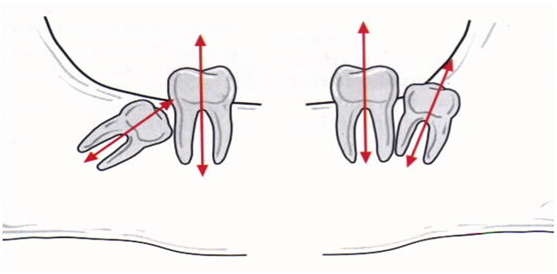 Dentistry and Medicine: Surgical management of Unerupted and Impacted teeth