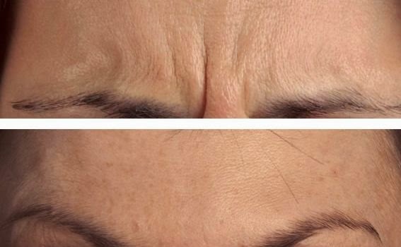 Look Younger With Facial Aerobics Exercises: Ultimate Non-Surgical ...