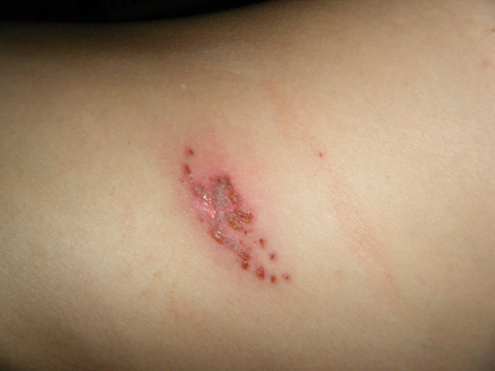 21 and Shingles: DAY 11: Yah scabby!!!!!!