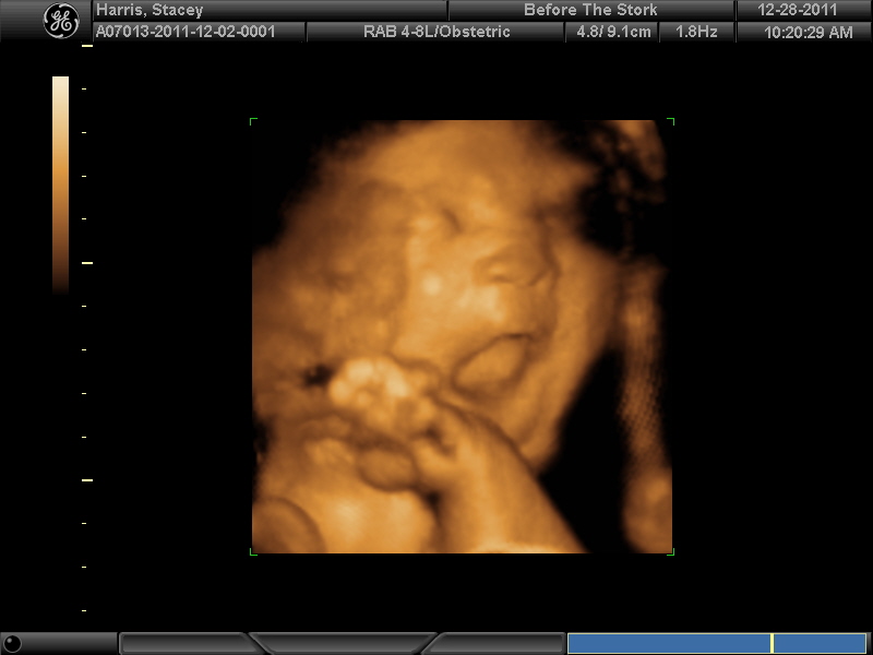 .: 32 Week 3D Ultrasound