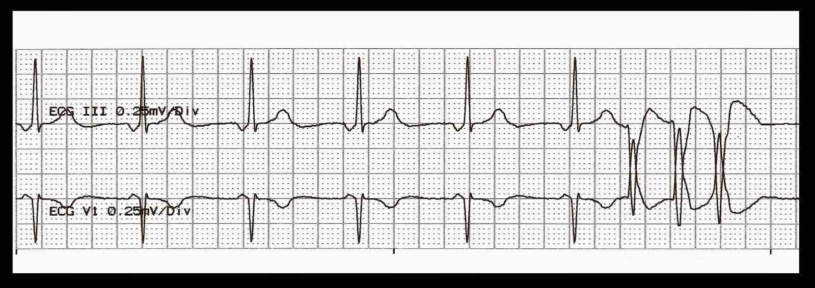 Practice EKG Strips 376