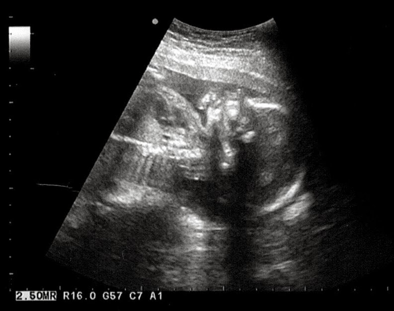 Baby Black's Blog: Anatomy Scan for Baby #3