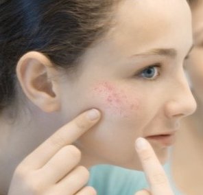 Berbagai Mitos tentang Jerawat yang Perlu Kita Ketahui